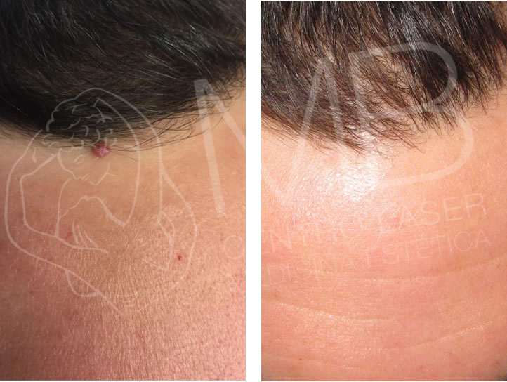 Angiomi - Poliambulatori San Gaetano